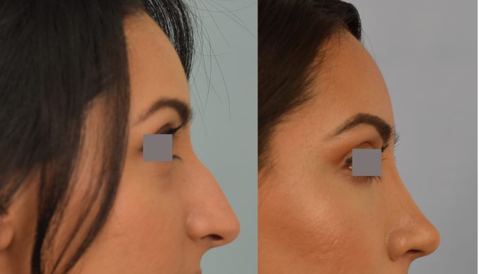 Long term results after rhinoplasty. - Rhinoplasty Los Angeles | Best ...