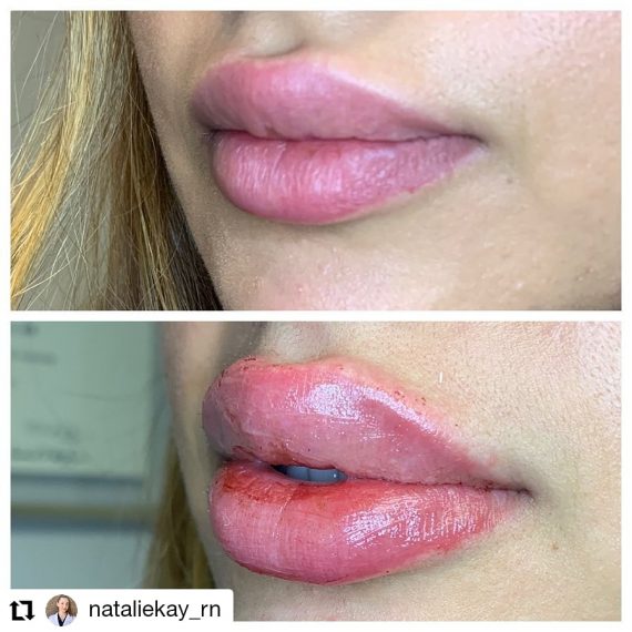Lip Fillers Los Angeles | Russian Lip Technique | Best Injections Options