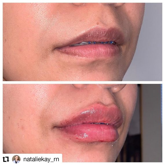 Lip Fillers Los Angeles | Russian Lip Technique | Best Injections Options