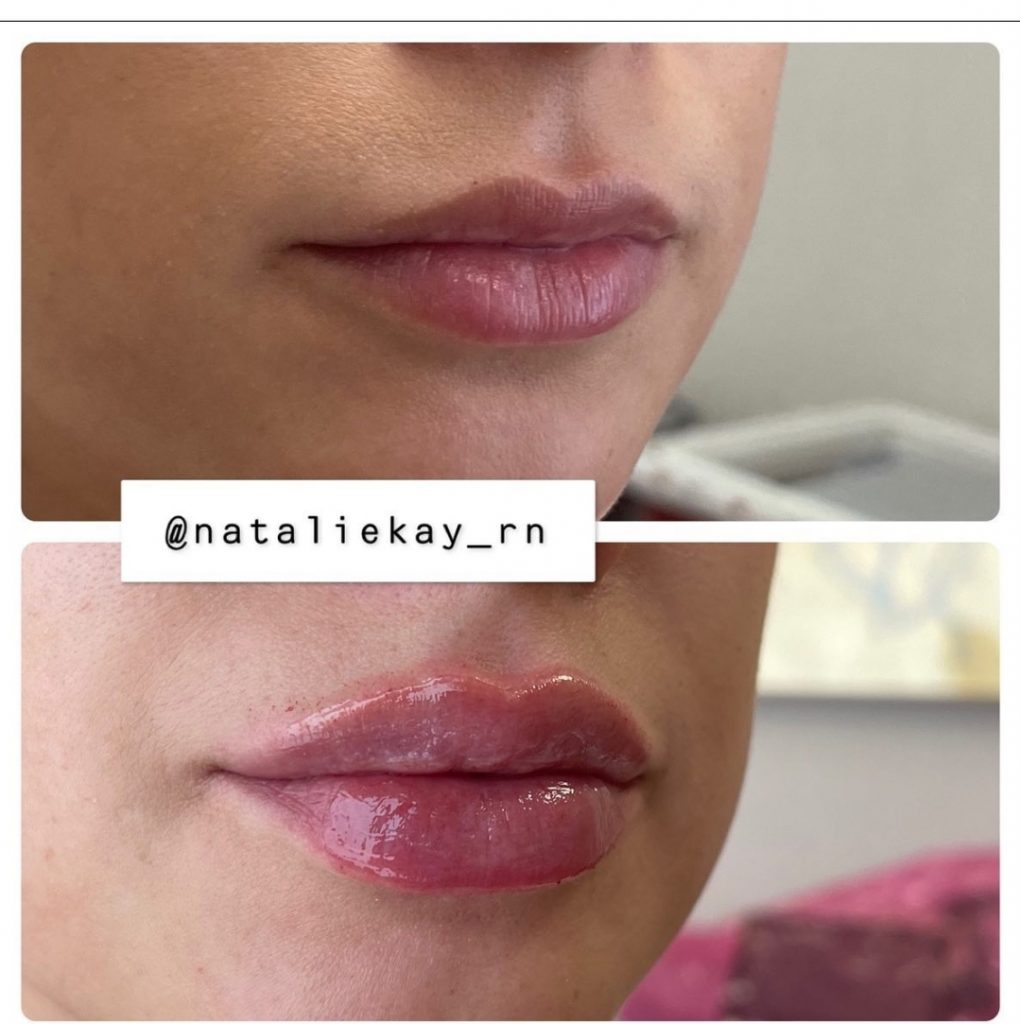 Lip Fillers Los Angeles | Russian Lip Technique | Best Injections Options